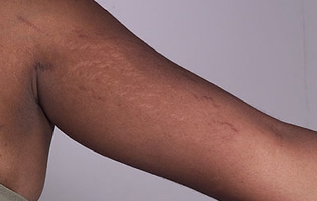 Managing/Treating Stretch Marks - Vanguard Allure