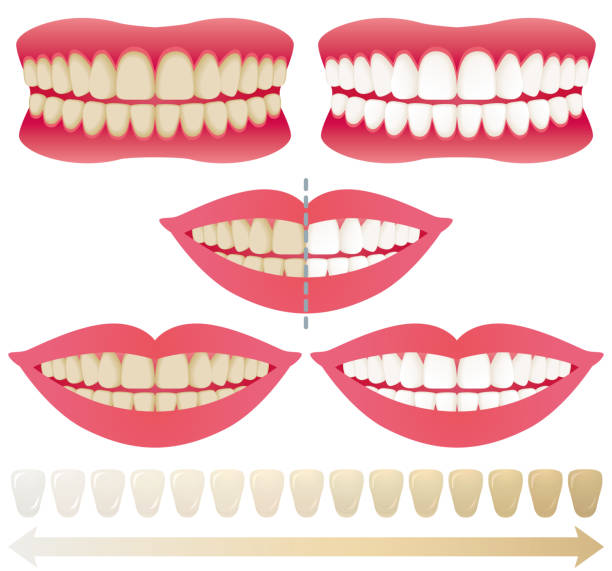 Causes of yellow teeth and natural remedies - Vanguard Allure