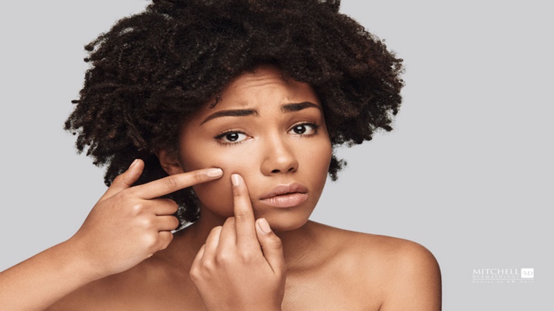 5 weird things that treat acne and pimples - Vanguard Allure